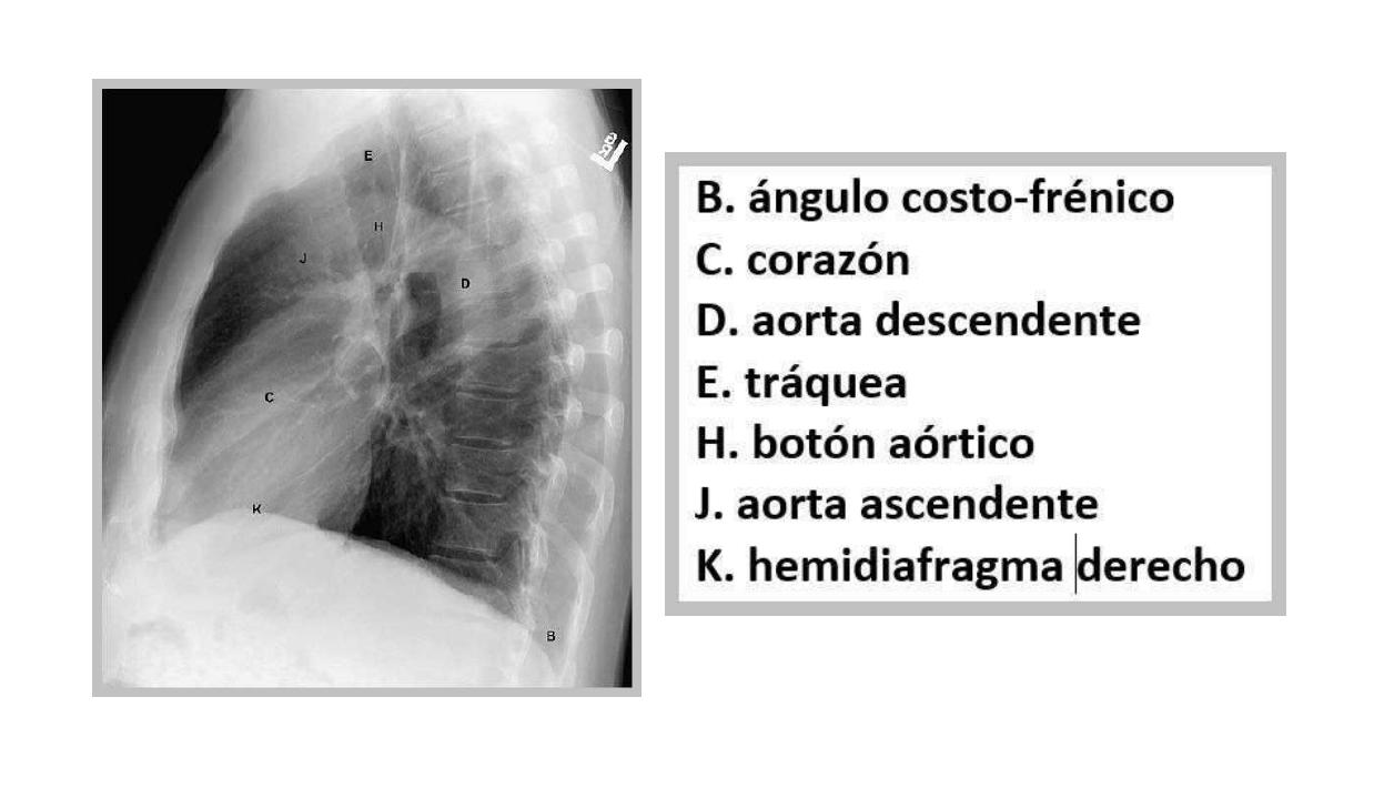 Anatomía De La Radiografía Lateral Del Tórax