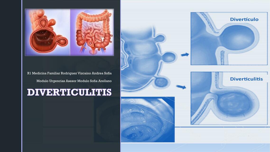 Flashcards de DIVERTICULITIS | Por Andrea Sofia | uDocz