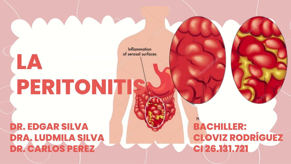 Flashcards de Peritonitis | Por cloviz vz | uDocz