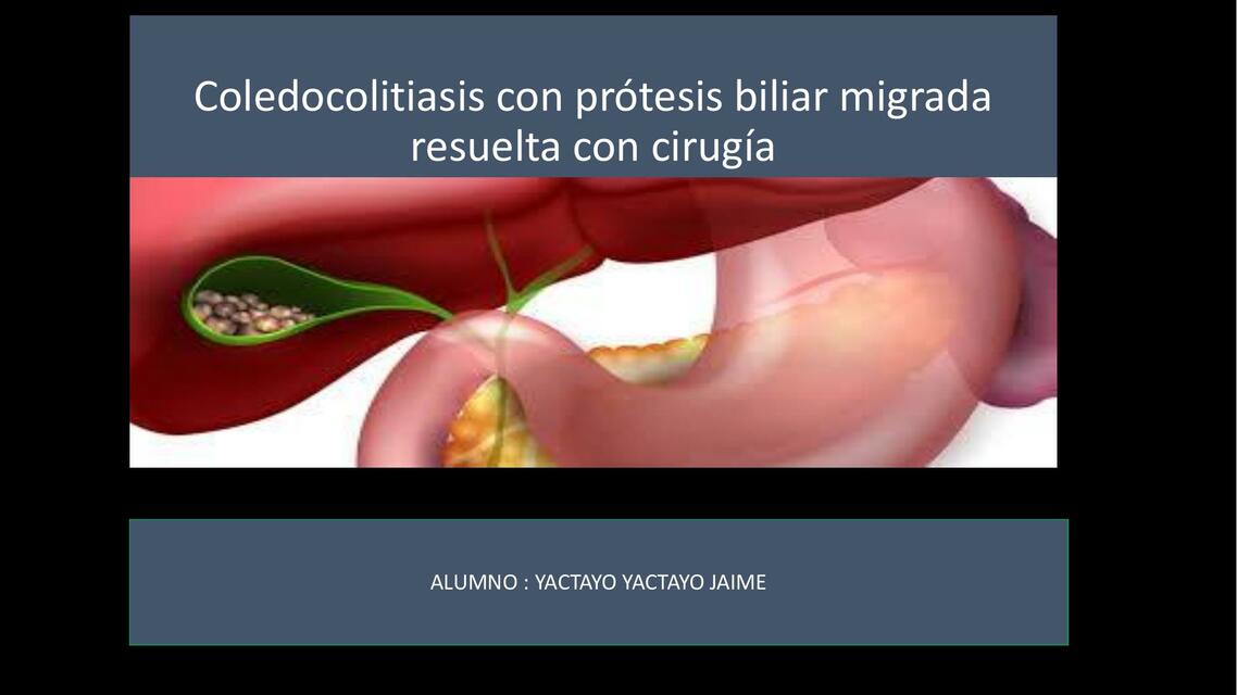 COLEDOCOLITIASIS YACTAYO | diego | uDocz