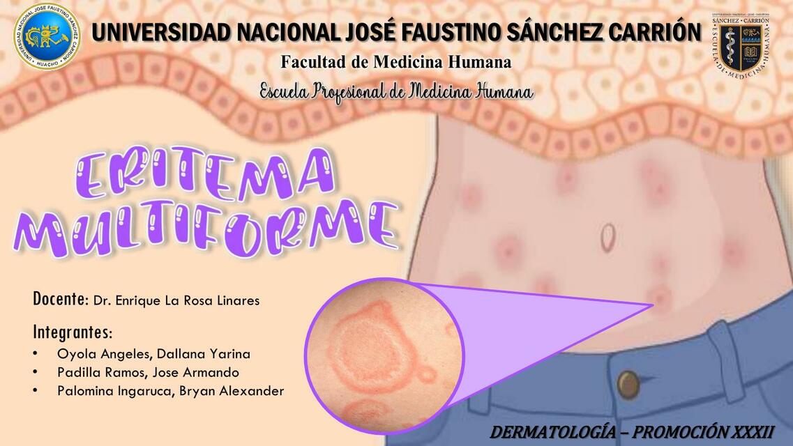 ERITEMA MULTIFORME | Apuntes Medicos | uDocz