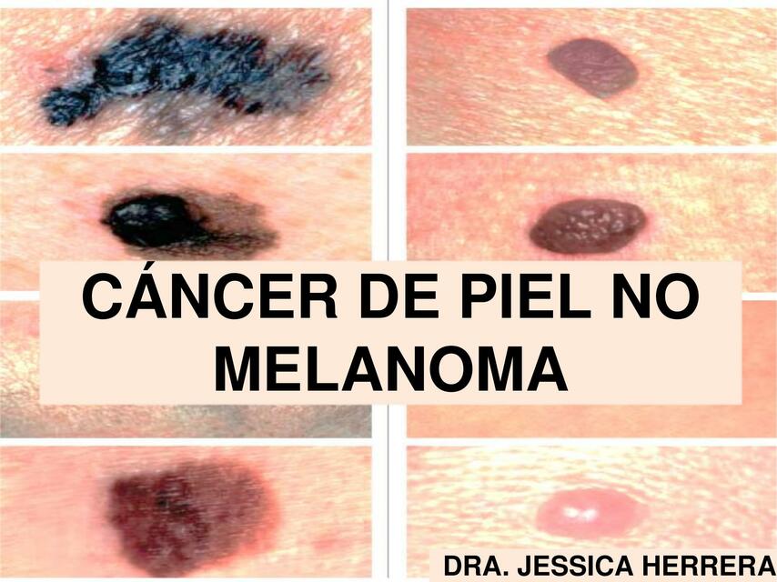 Cancer De Piel No Melanoma Udocz