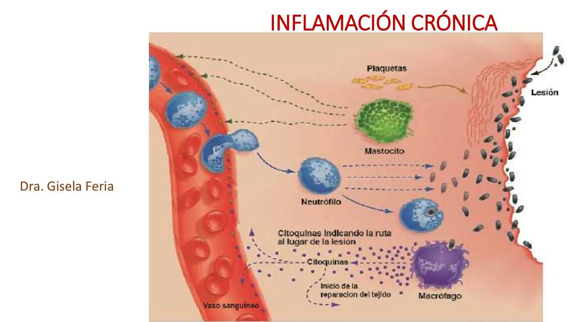 INFLAMACIÓN CRÓNICA | uDocz