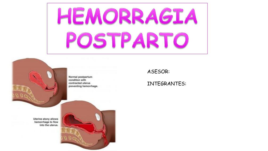 HEMORRAGIA POSPARTO CASO CLINICO | Diana Lucía | uDocz