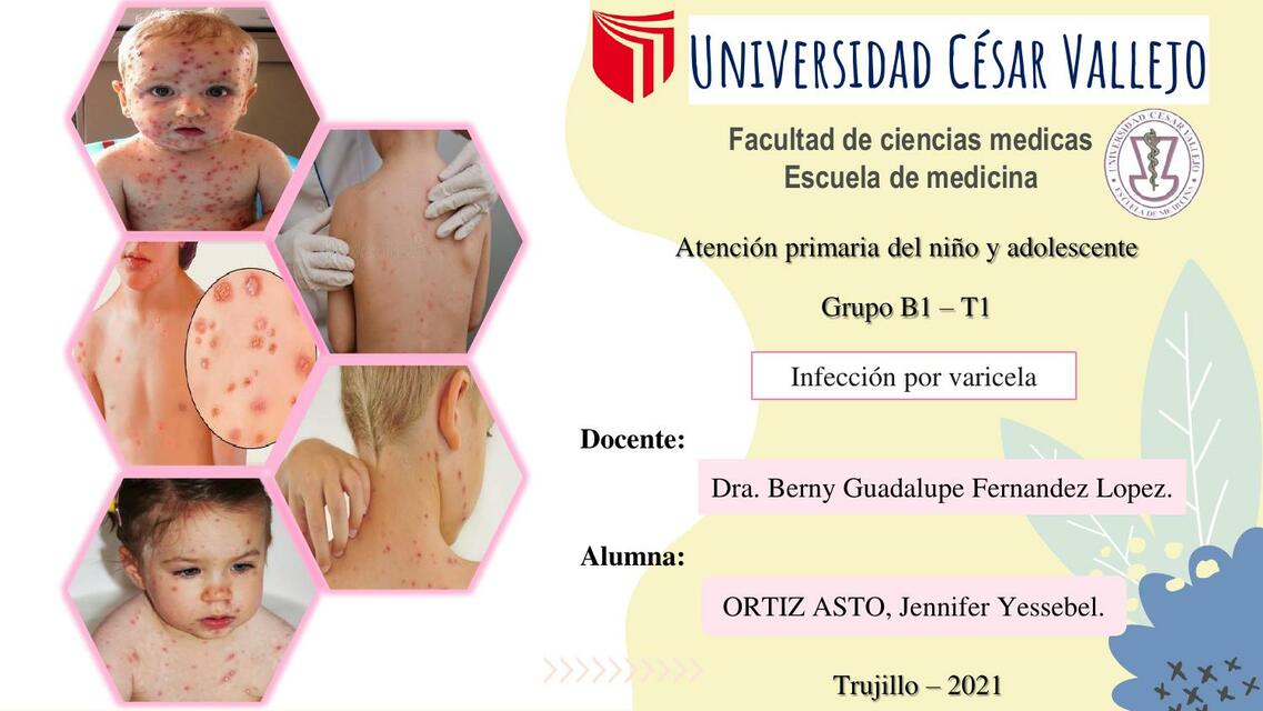 Varicela | Maria Stefany Chuquitucto Torres | uDocz