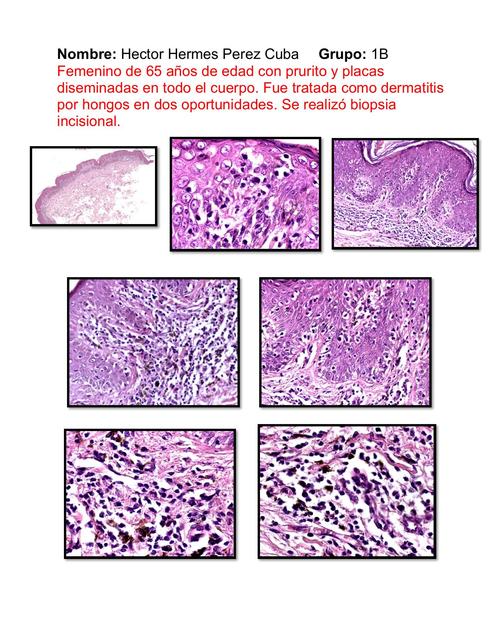 Mucosis fungoide | DEEP MEDICINE | uDocz