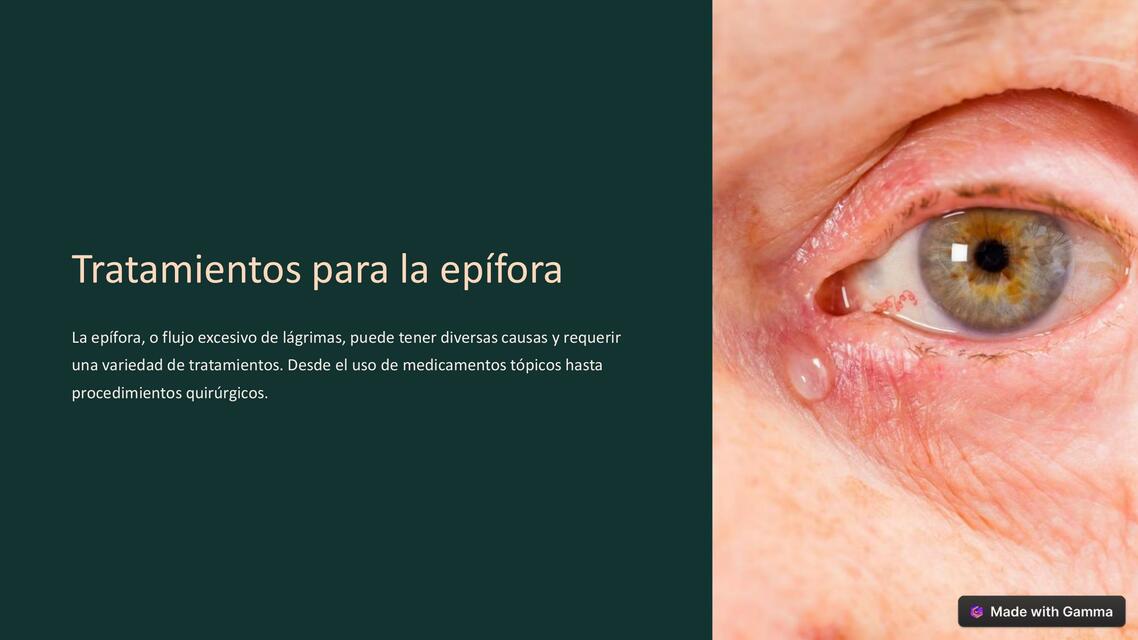 Tratamientos para la epifora | Eduardo | uDocz
