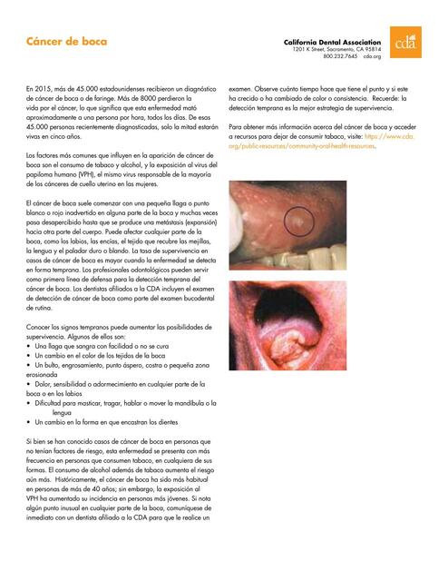 Cáncer de boca | META | uDocz