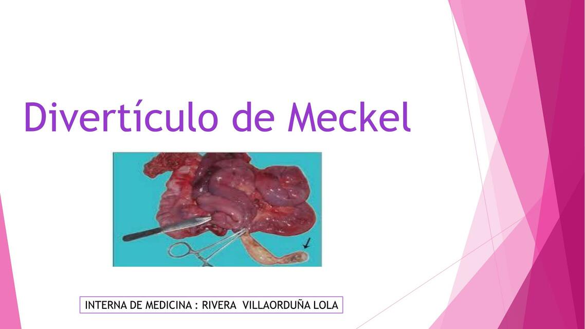 diverticulo de meckel expo | Marina | uDocz