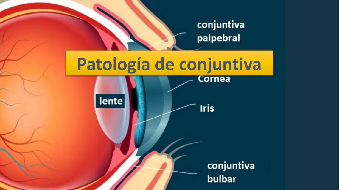 Flashcards de PATOLOGÍA DE LA CONJUNTIVA | Por Fernanda Pro | uDocz