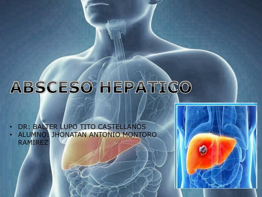 ABSCESO HEPATICO | JHONATAN ANTONIO MONTORO RAMIREZ | uDocz