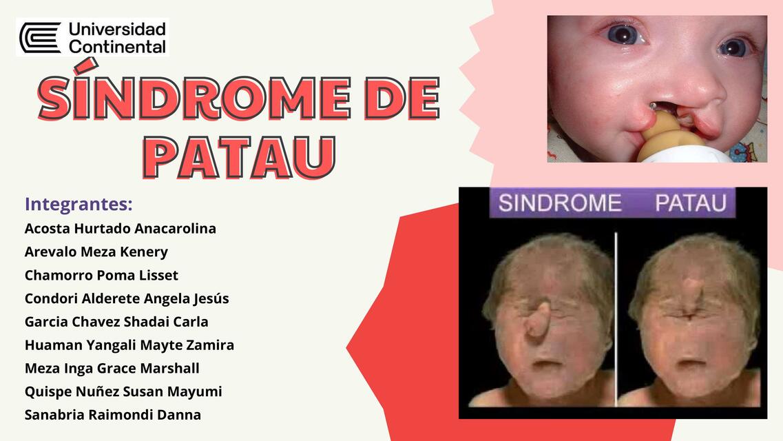 Síndrome de Patau compressed | Marifer Alife | uDocz