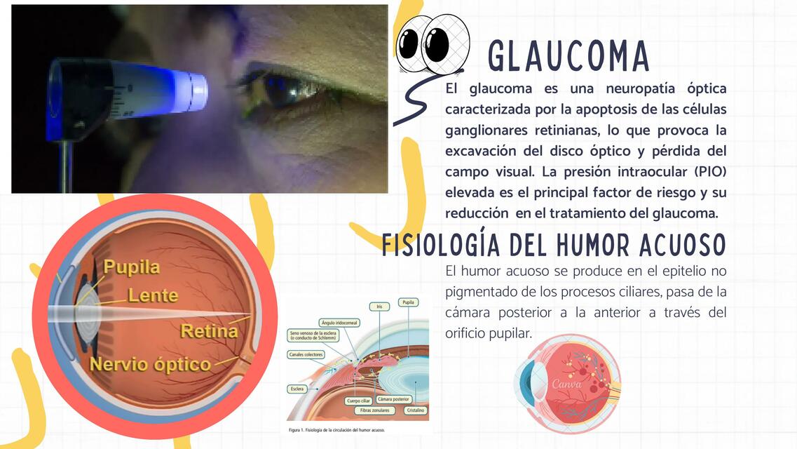 GLAUCOMA 2 | ruth | uDocz