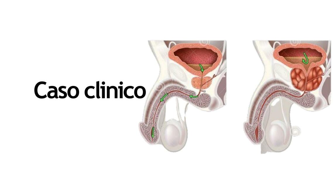 Caso clinico DE Hiperplasia Benigna de Prostata | Lupita | uDocz Caso clinico DE Hiperplasia Benigna de Prostata | Lupita | uDocz