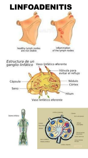 Infografía de linfoadenitis | uDocz