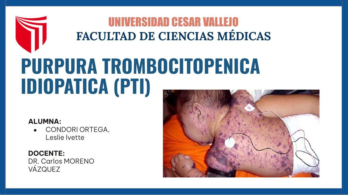 PURPURA TROMBOCITOPENICA IDIOPATICA | Marlene Olinda Arrascue campos ...