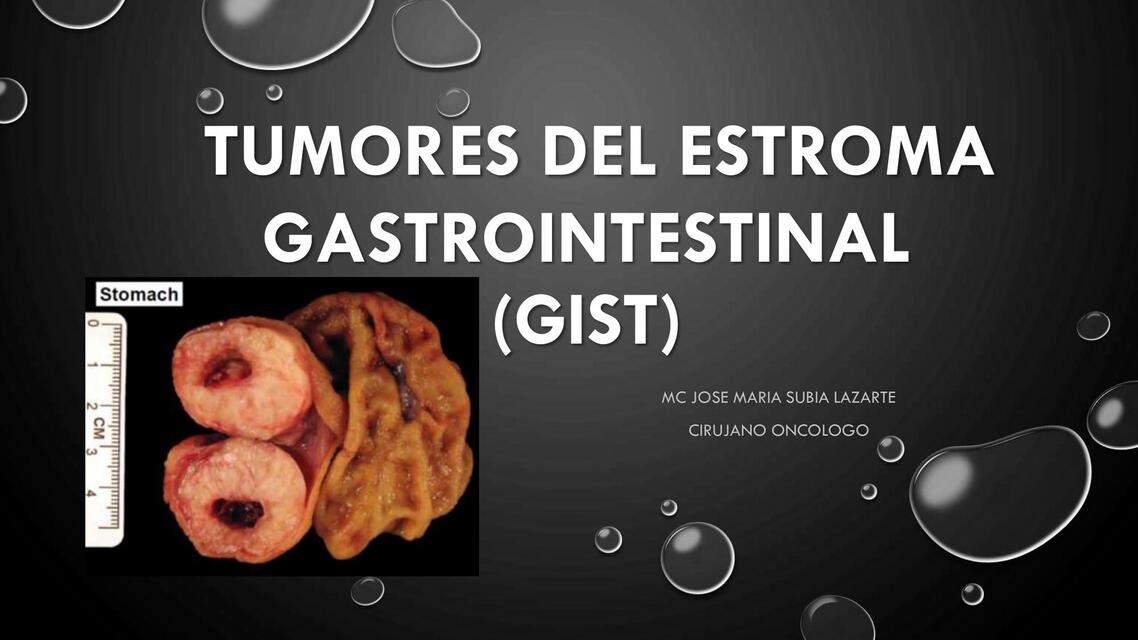 GIST tumor | Rodrigo Zevallos Rodríguez | uDocz