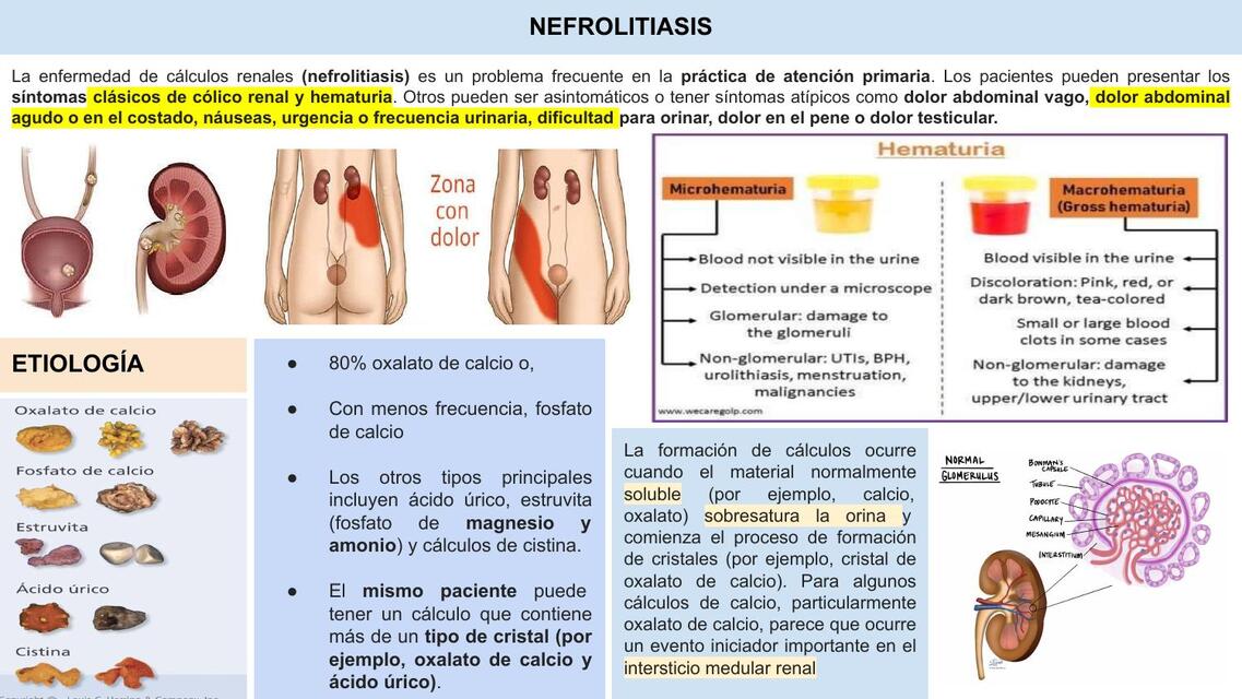 NEFROLITIASIS ECOE NEFROLOGÍA UCSUR | Medical student Kath ESGA🩺☀️ | uDocz