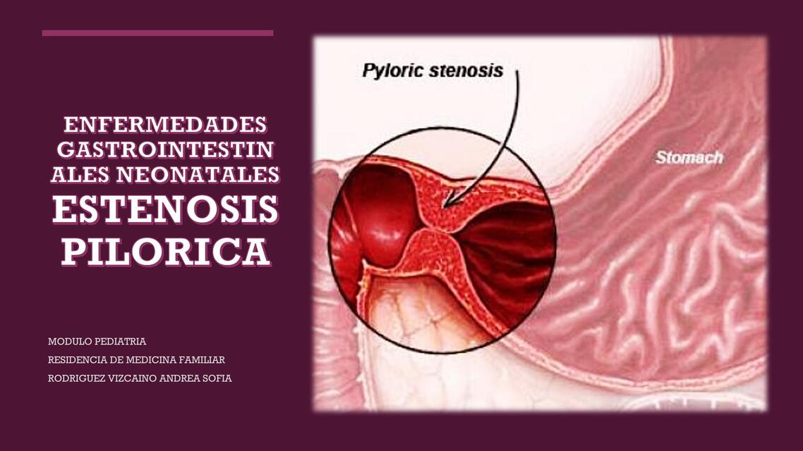 ESTENOSIS PILORICA | Andrea Sofia | uDocz