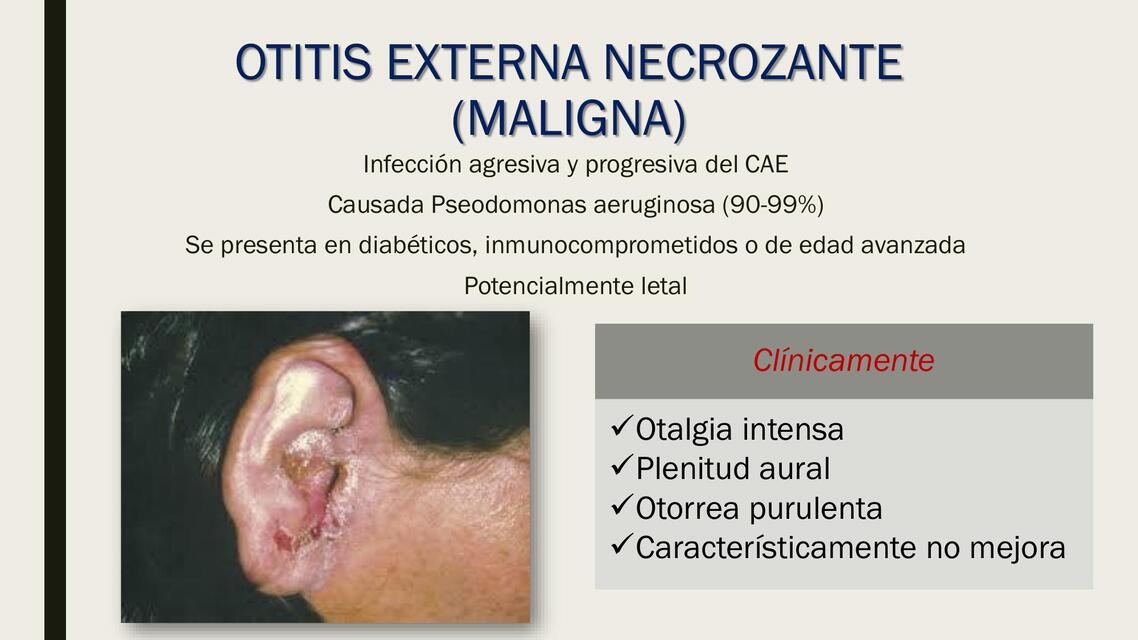 OTITIS EXTERNA NECROZANTE MALIGNA | Monica Patricia | uDocz