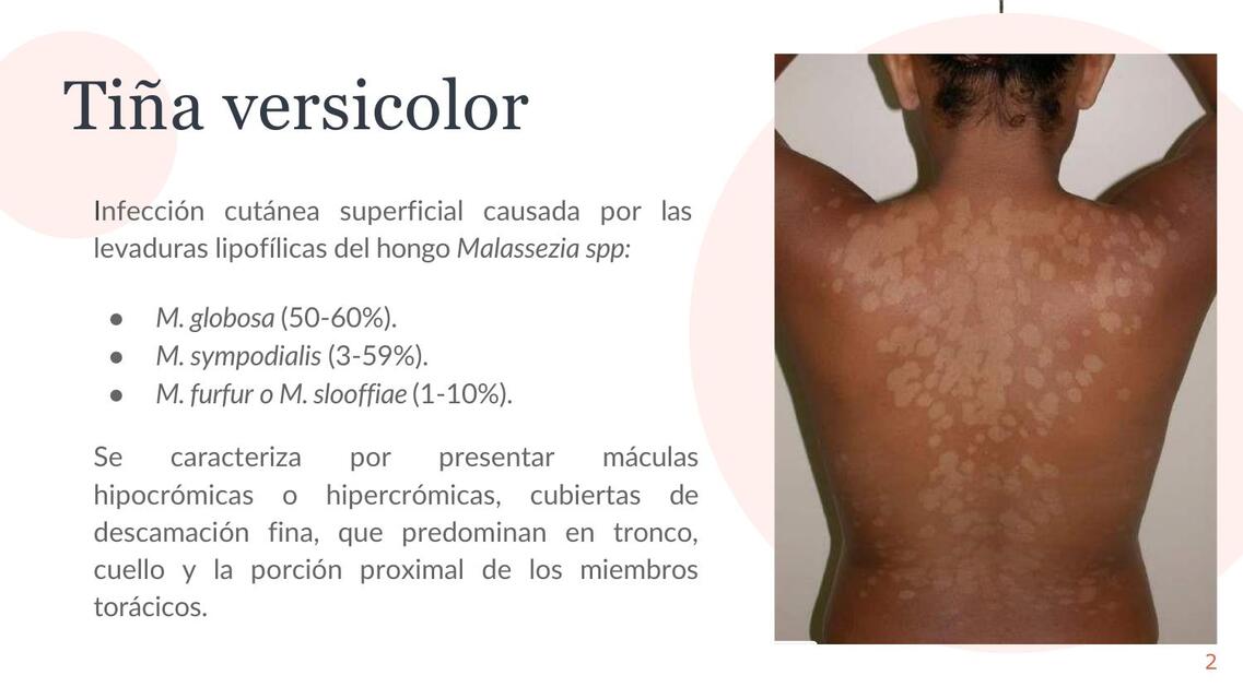 tiña versicolor | compu de carton 02 carton | uDocz