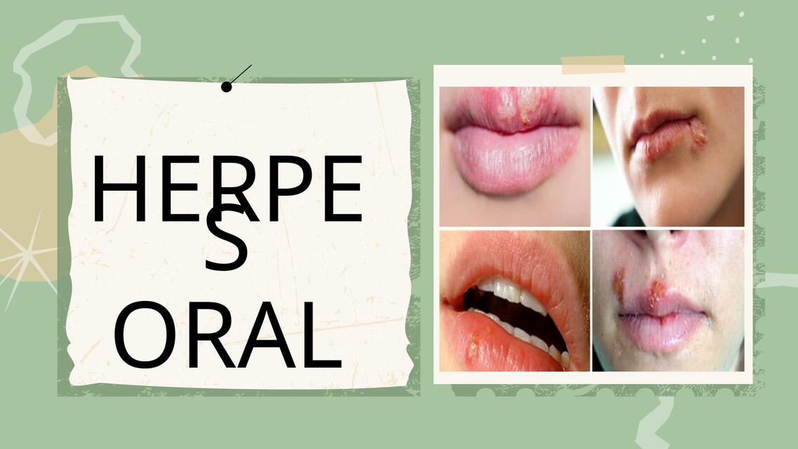 HERPES ORAL 2 | Grecia Andrea | uDocz