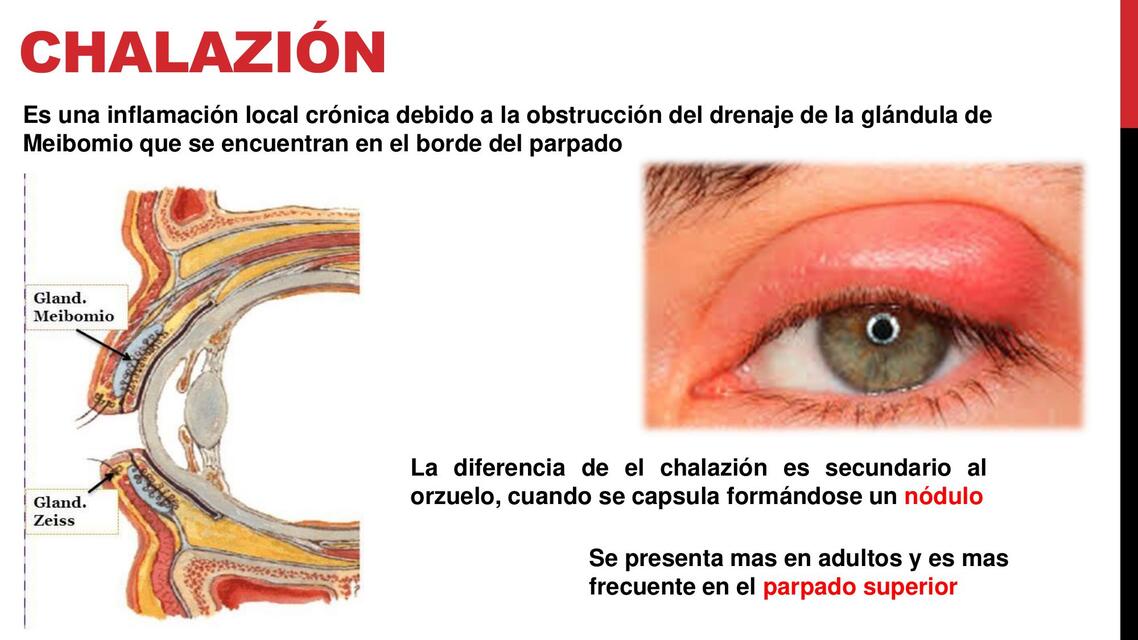 orzuelo chalazion y blefaritis | Martin Huallpa | uDocz