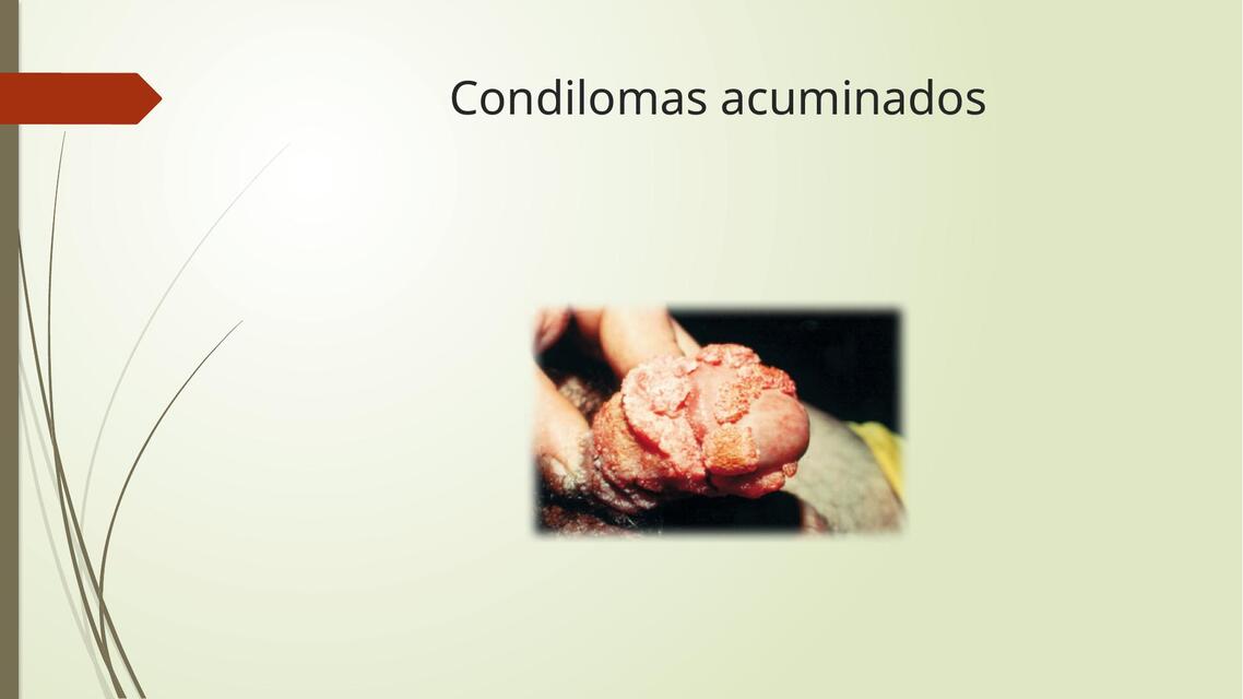 Condiloma Acuminado | Joselyn | uDocz