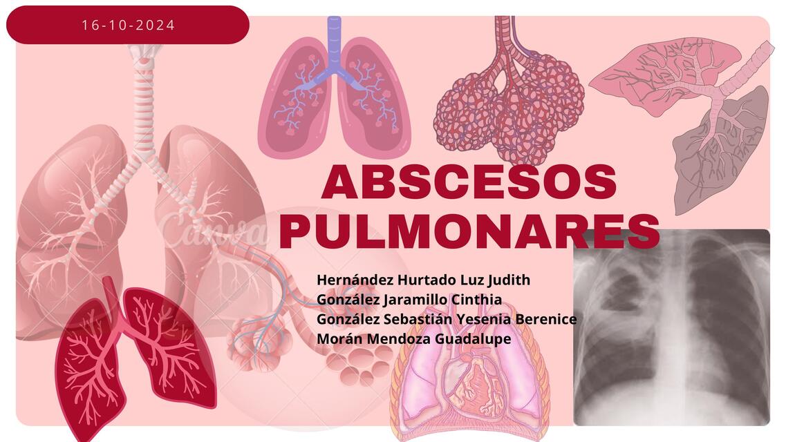 Abscesos pulmonares | judith hernandez | uDocz