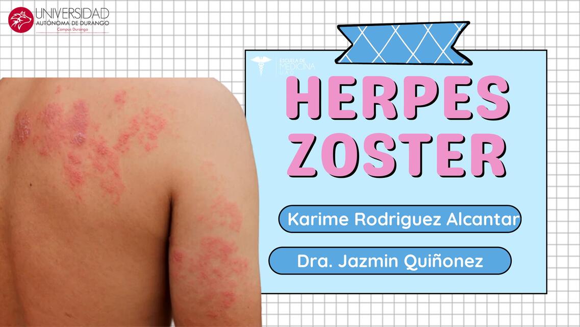 Herpes zoster | Karime Alcnata | uDocz