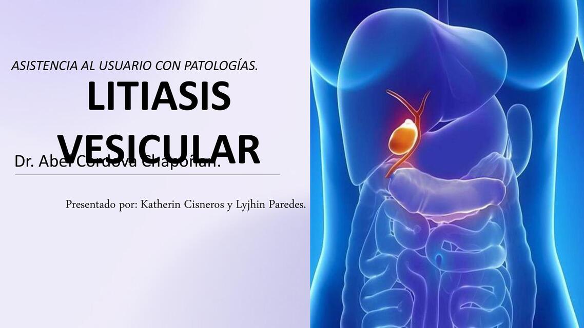 LITIASIS VESICULAR | LYJHIN PAREDES MONTOYA | uDocz