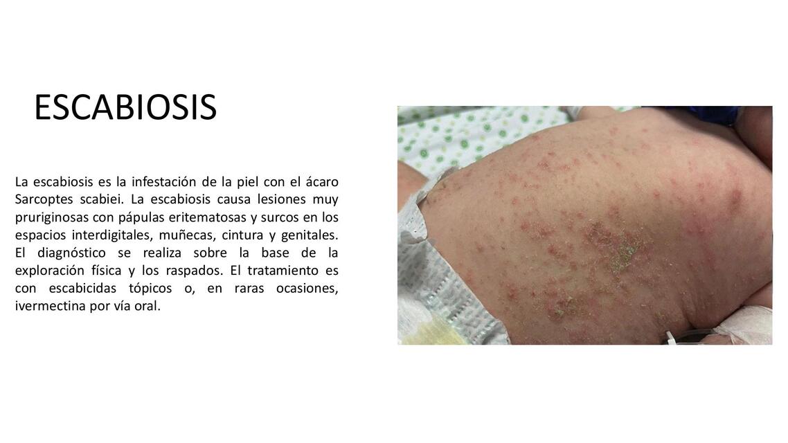 Escabiosis | Maria Angela | uDocz