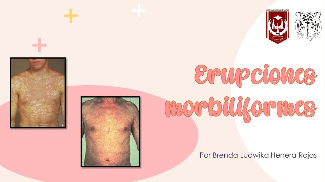 Erupciones morbiliformes | Med Share Lud | uDocz
