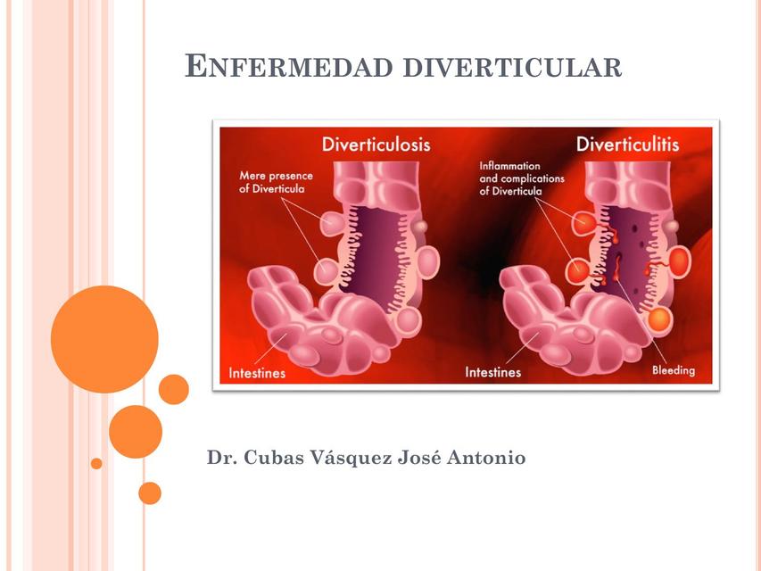 Diverticulosis | Héctor Dávila | uDocz