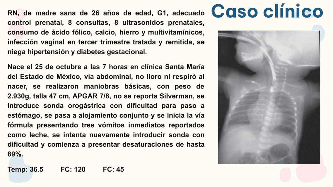 Atresia esofagica | G | uDocz