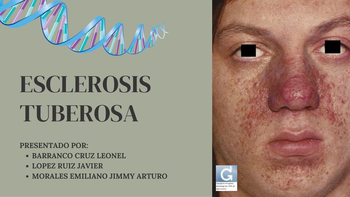 Esclerosis TUberosa | Javier | uDocz