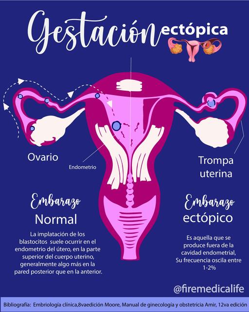Embarazo ectopico | drs.inmunoglobulinas | uDocz