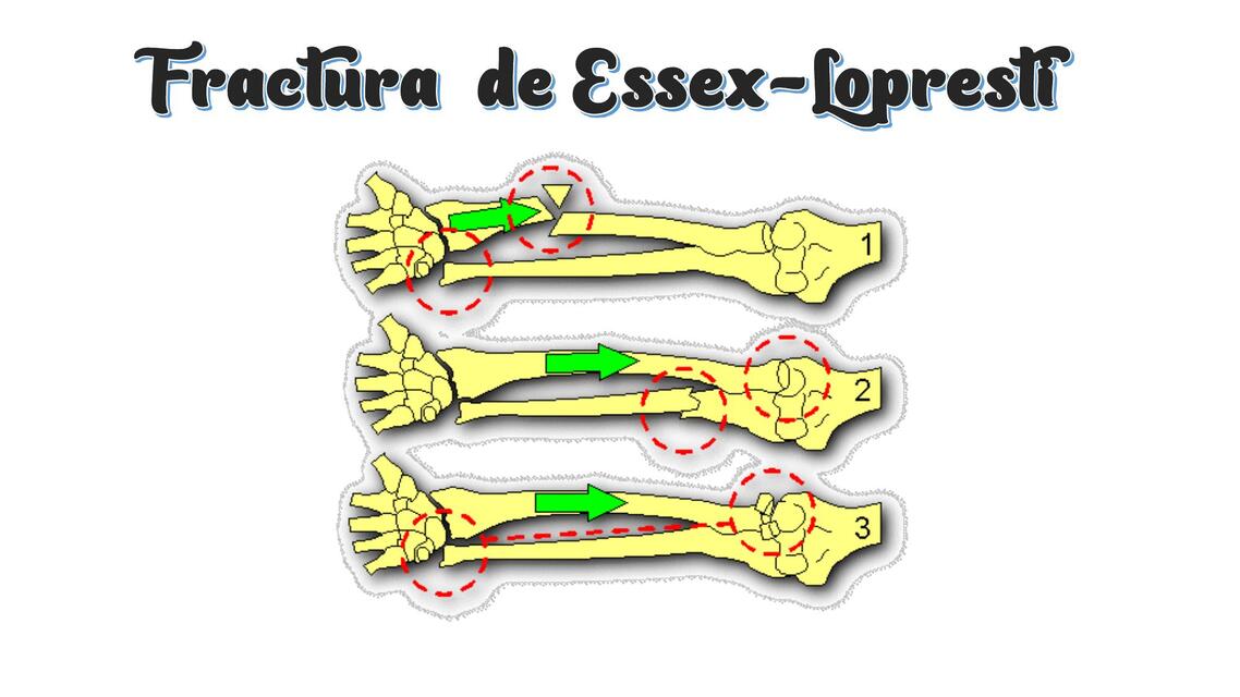 FRACTURA DE ESSEX LOPRESTI GAMA | gamaliel c | uDocz