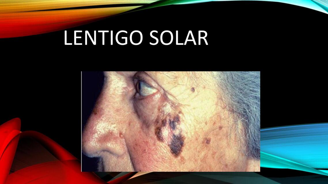 LENTIGO SOLAR | Marlen | uDocz