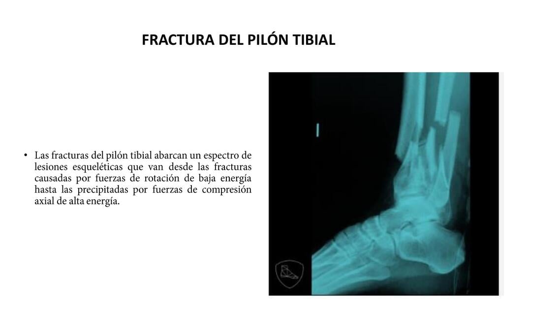 FRACTURA DEL PILÓN TIBIAL | J Rogelio | uDocz