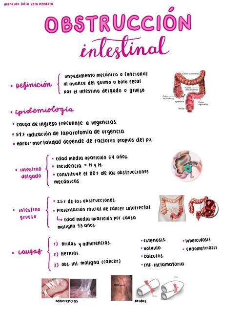 Obstrucción Intestinal | Sofía Vera | uDocz
