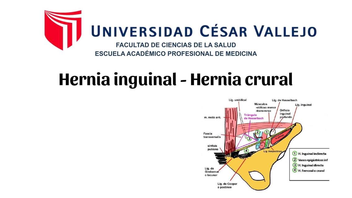 Hernia inguinal y Hernia crural 1 | AMIR CASTILLO ROSAS | uDocz