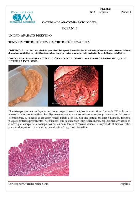 F6 GASTRITIS CRONICA Y CRONICA ACTIVA | christopher neira | uDocz