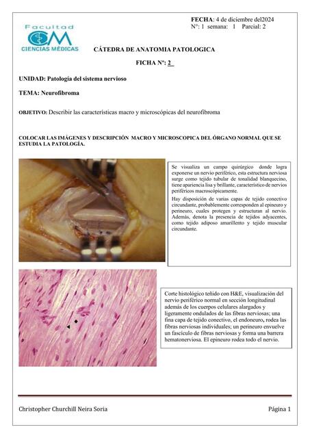NEUROFIBROMA | christopher neira | uDocz
