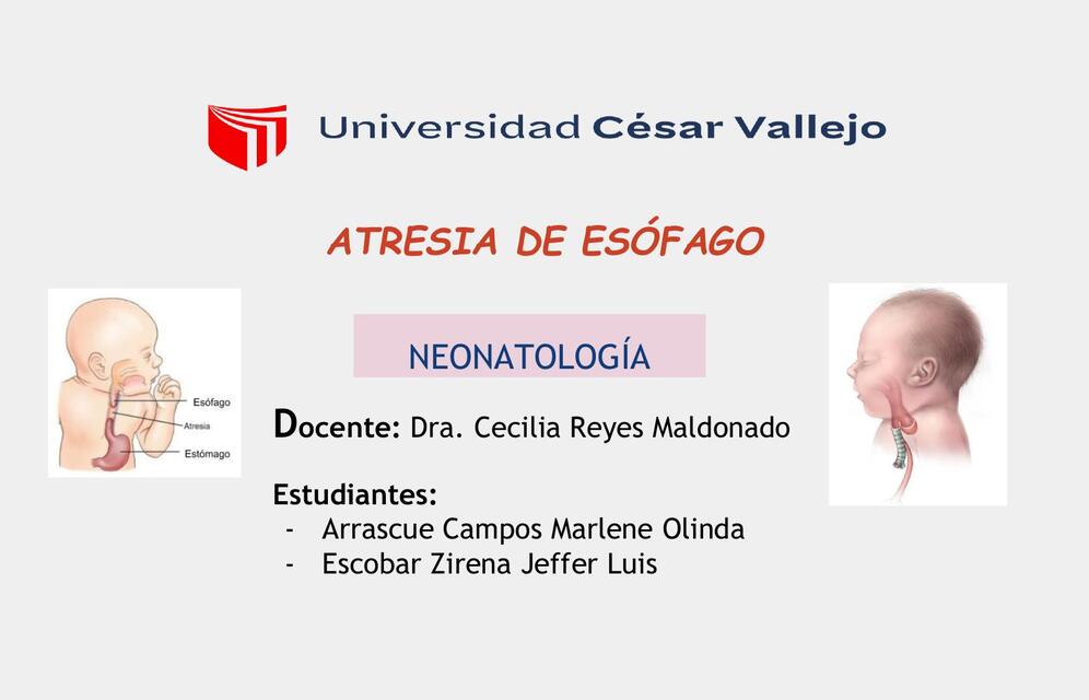 Atresia de esófago | Marlene Olinda Arrascue campos | uDocz