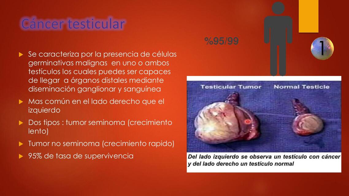 Flashcards de cancer de testiculo UROLOGIA | Por Jose Francisco ...