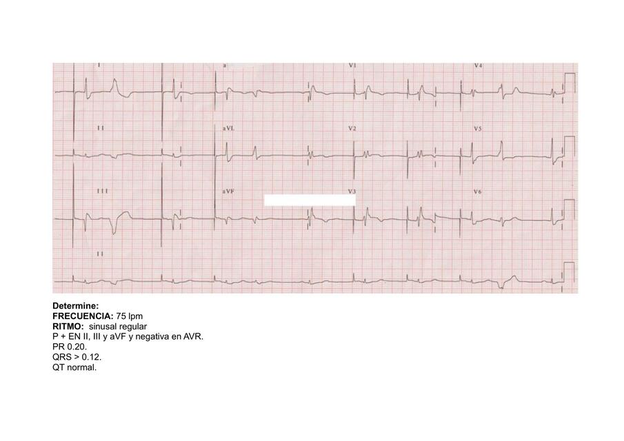 ECG BIR | Ricardo loza arce | uDocz