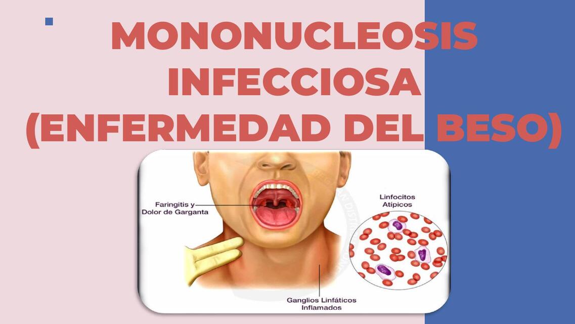 MONONUCLEOSIS INFECCIOSA | Yubely Gálvez | uDocz