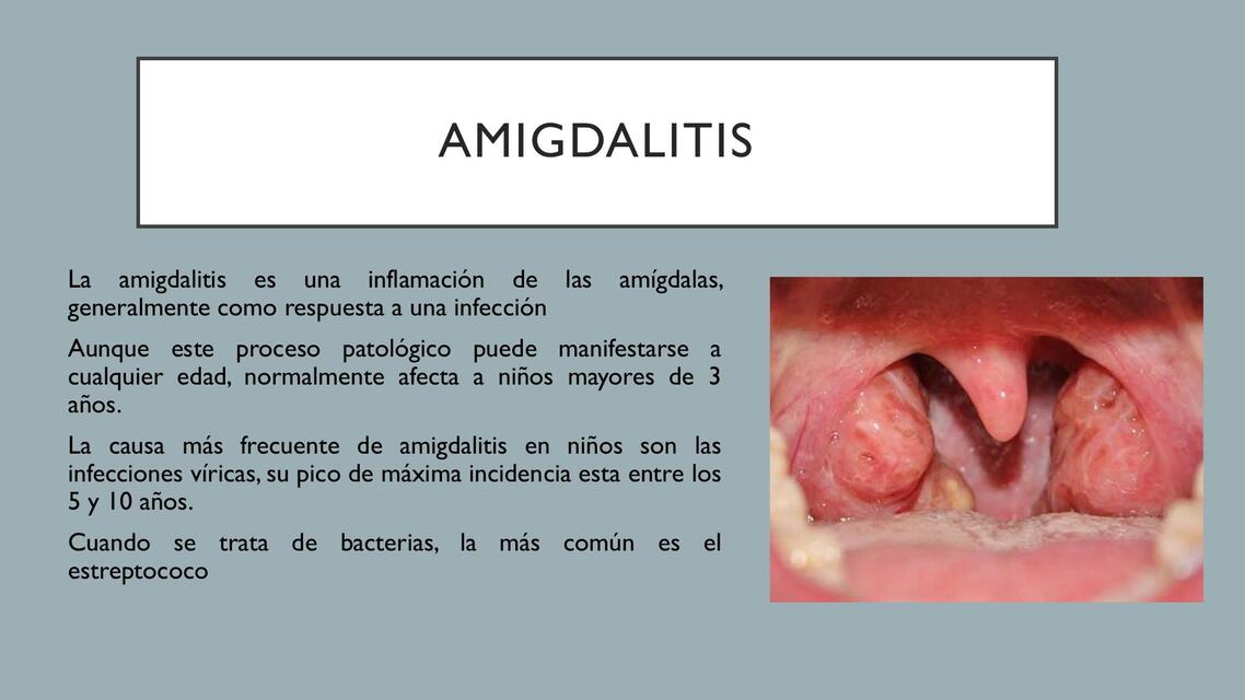 Amigdalitis | Alexandra Zeledón | uDocz