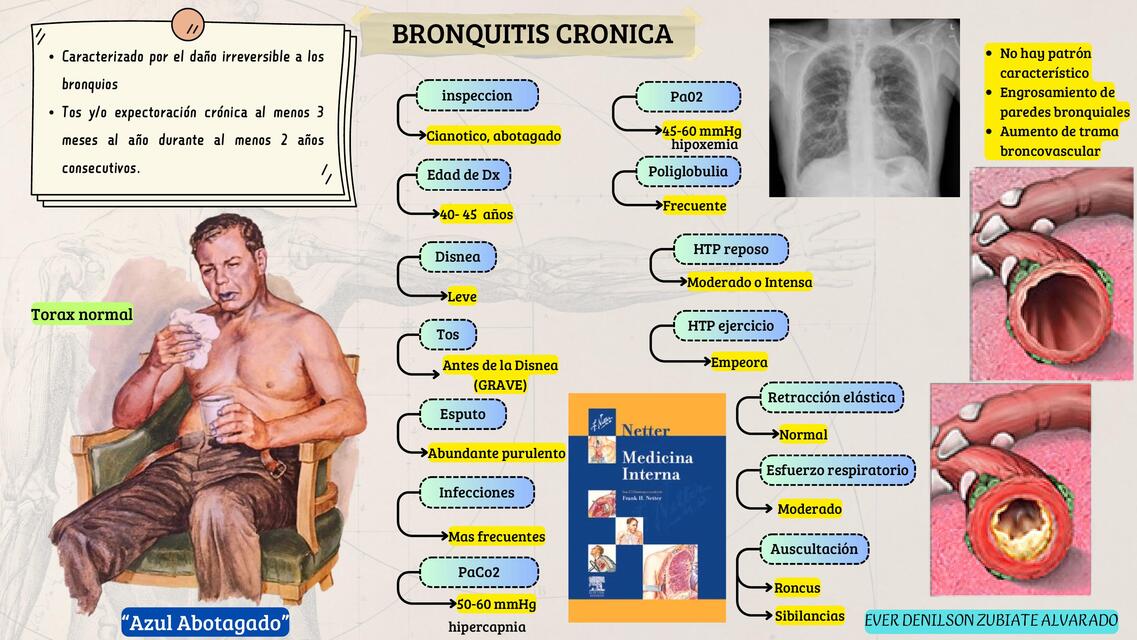 BRONQUITIS CRONICA | Denilson Zubiate | uDocz